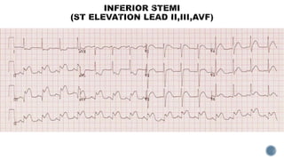 Acs ecg | PPTX | Heart and Cardiovascular Diseases | Diseases and ...