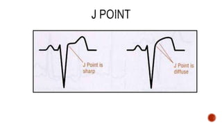 Acs ecg | PPTX | Heart and Cardiovascular Diseases | Diseases and ...