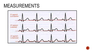 Acs ecg | PPTX | Heart and Cardiovascular Diseases | Diseases and ...