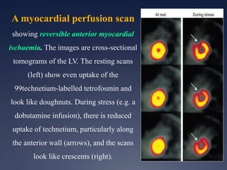 Acute Coronary Syndrome, Myocardial Infarction. | PPTX