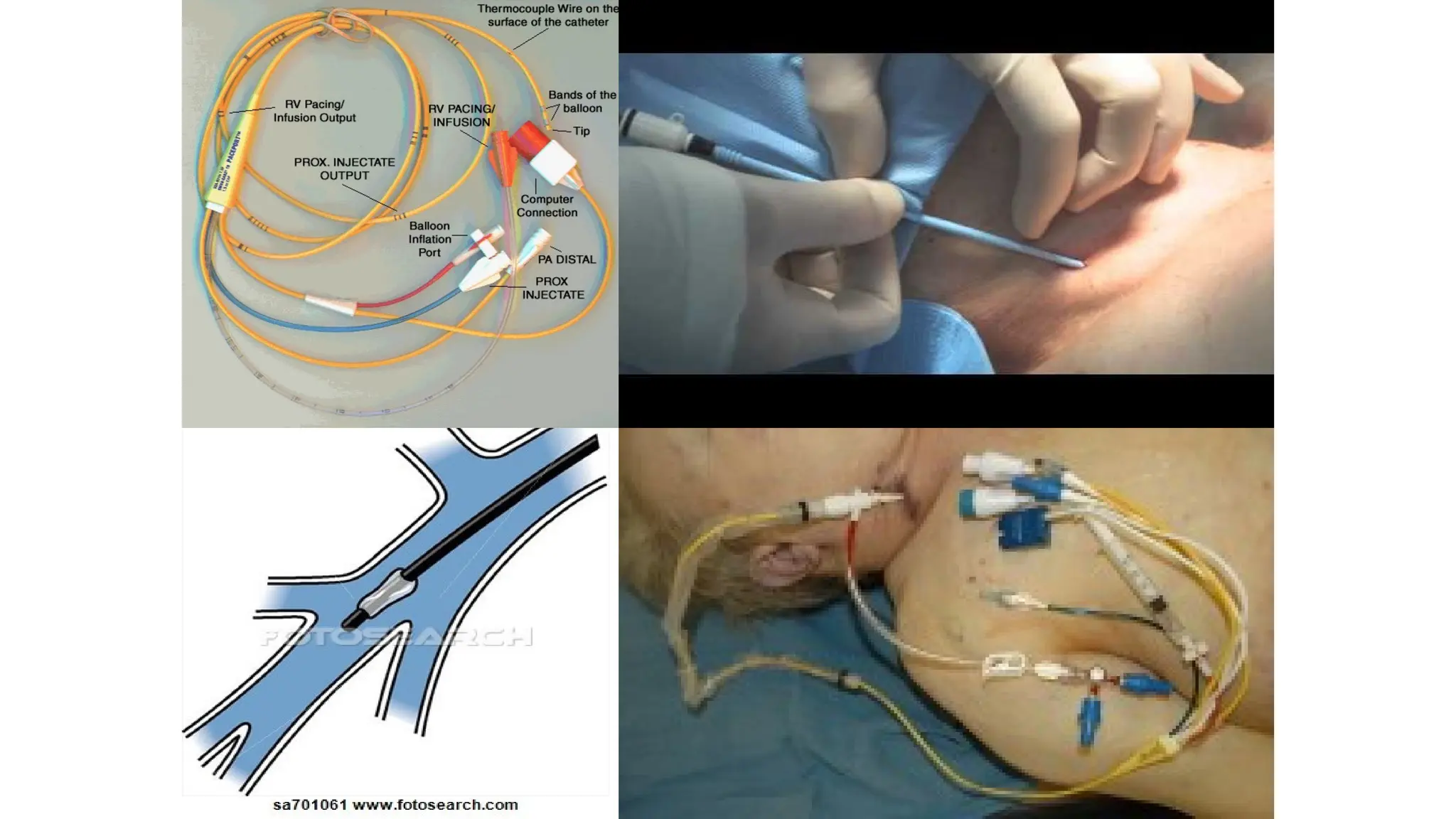 Acute Coronary Syndrome, Heart failure, ARF.pptx
