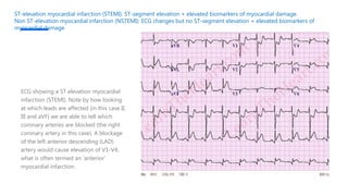 Presentation on Acute coronary syndrome | PPTX