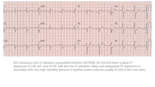 Presentation on Acute coronary syndrome | PPTX