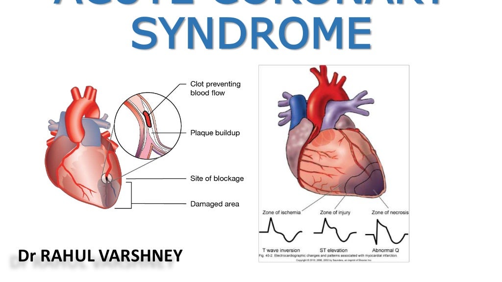 Acute Coronary Syndrome - Overview