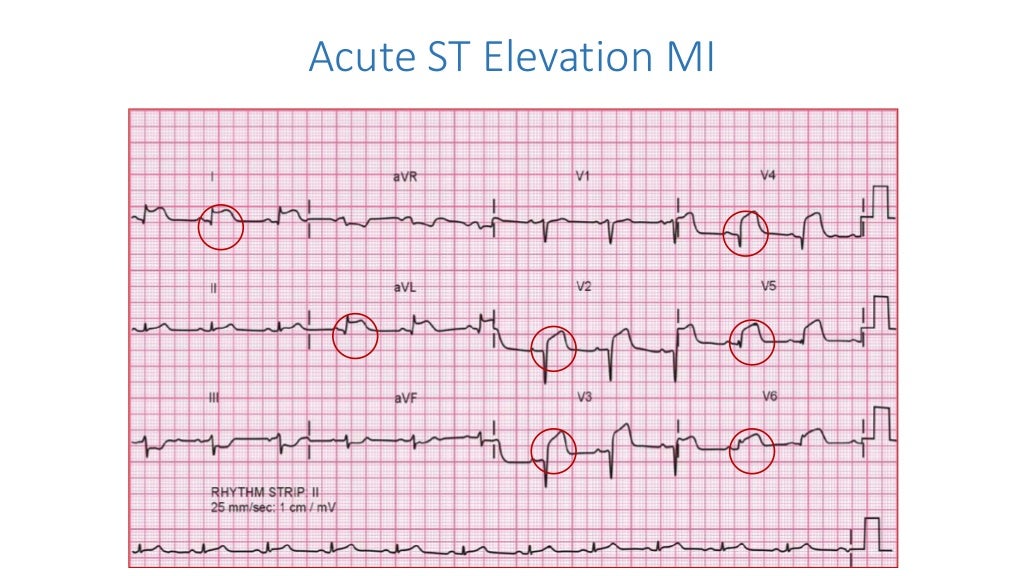 Acute Coronary Syndrome - Overview
