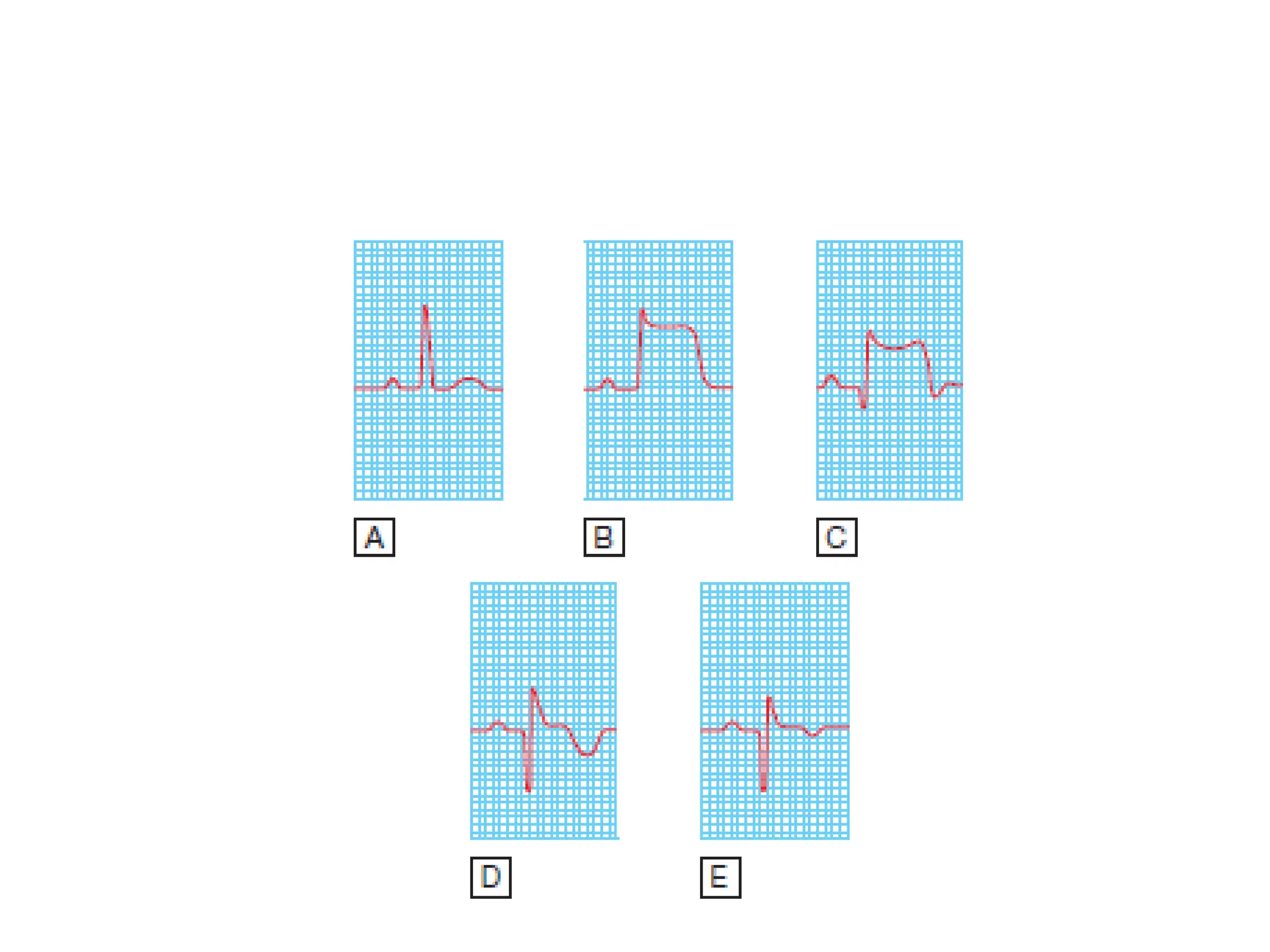 ACS (STEMI).pptx