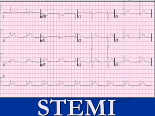 Acute Coronary Syndrome Management RRT | PPT