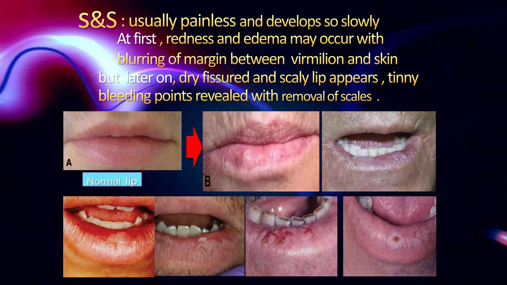 Actinic chelitis | PPTX