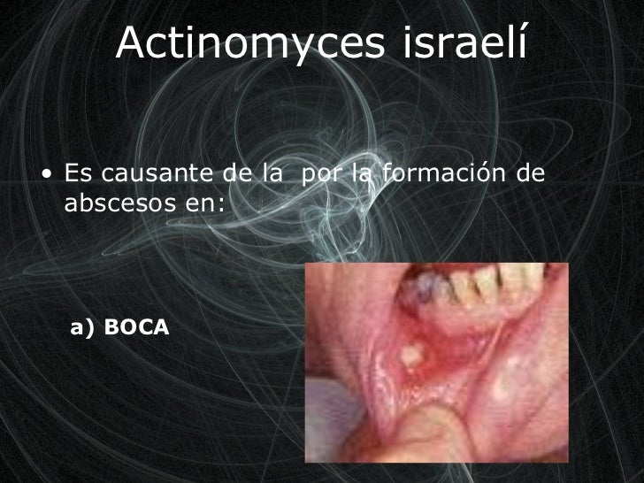 Actinomyces