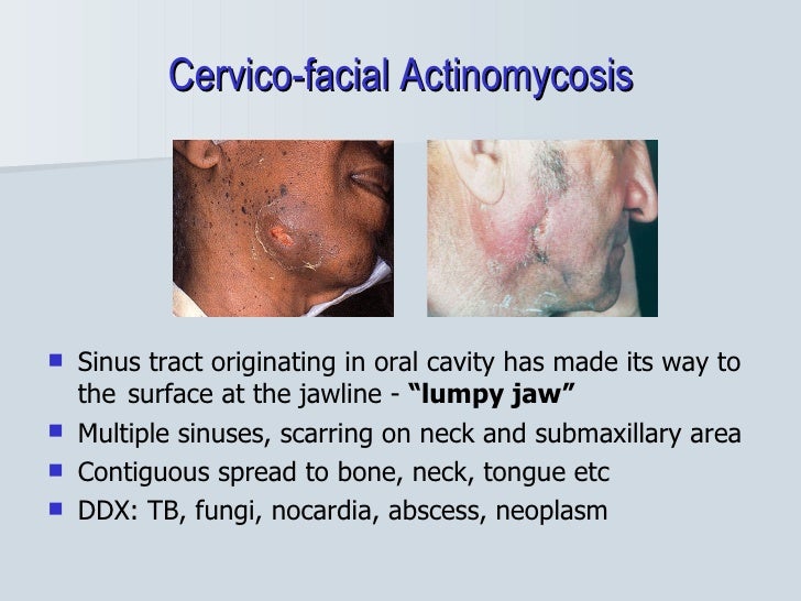 Actinomyces + nocardia