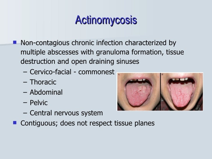 Actinomyces + nocardia
