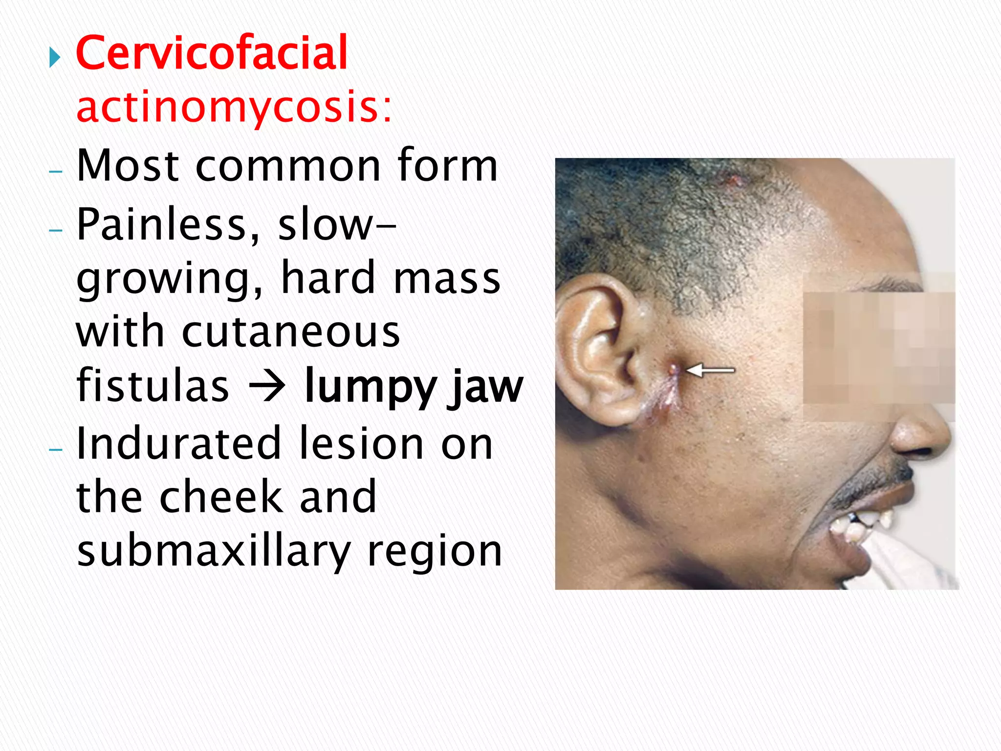 Actinomycetes and Nocardia | PPTX