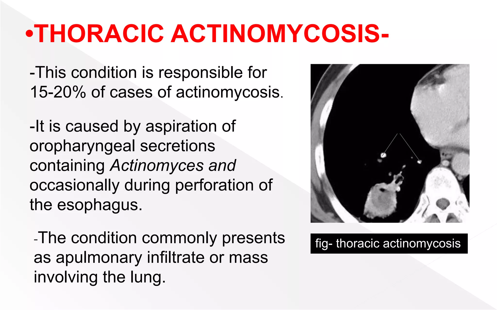 Actinomycosis | PDF