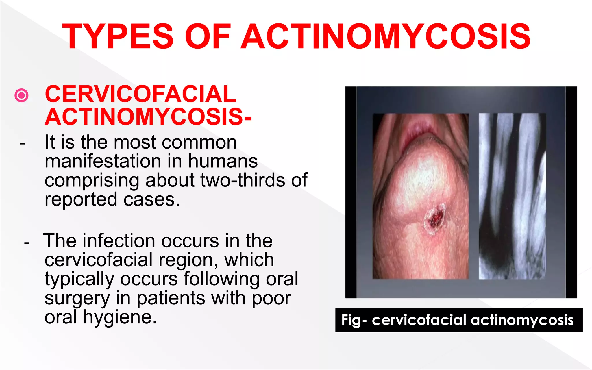 Actinomycosis | PDF