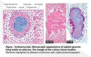 Actinomycosis | PDF