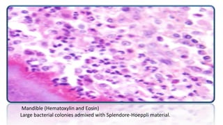 Actinomycosis (Lumpy Jaw) | PDF