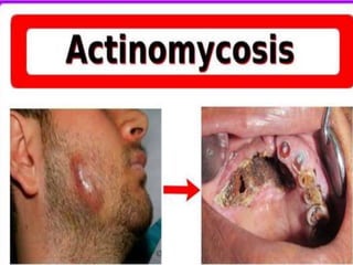 ACTINOMYCOSIS.pptx