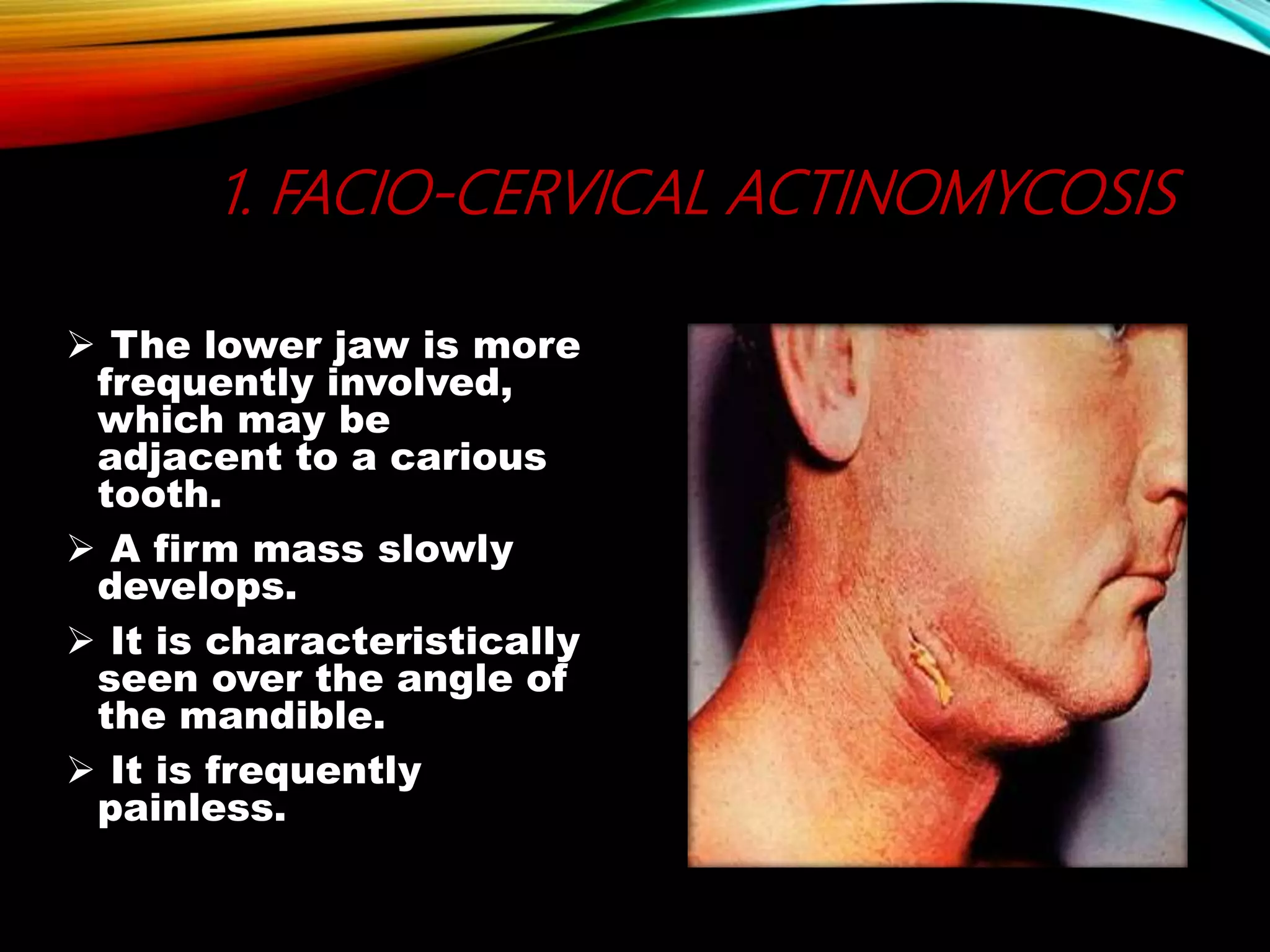 Actinomycosis Information | PPTX
