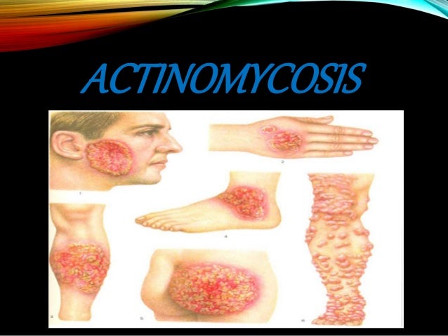 Actinomycosis Information