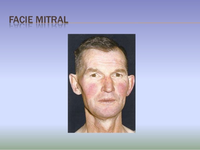 Facies Mitralis