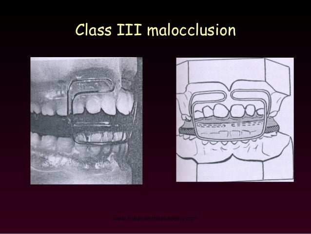 Activator and its modifications /certified fixed orthodontic courses