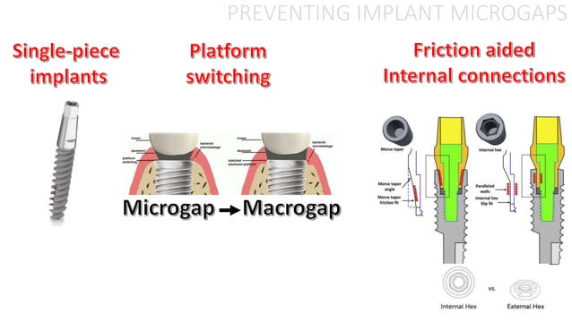 Active and passive implants and Microgap around implants | PPTX