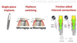 Active and passive implants and Microgap around implants | PPT