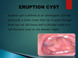 activity pathology (odontogenic cysts).pptx