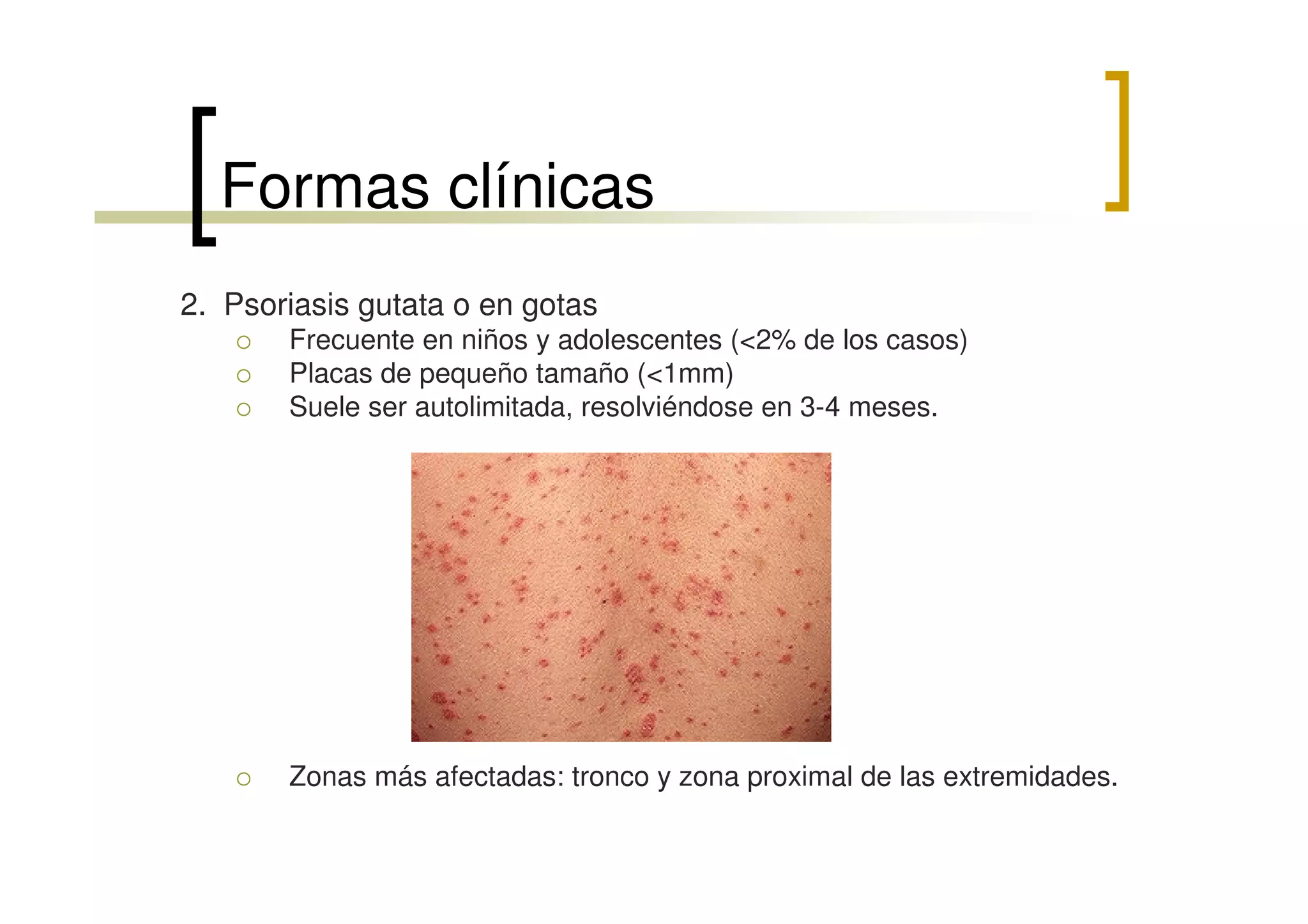 Actualización en el tratamiento de psoriasis | PDF