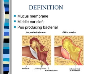 Actue otitis media | PPT