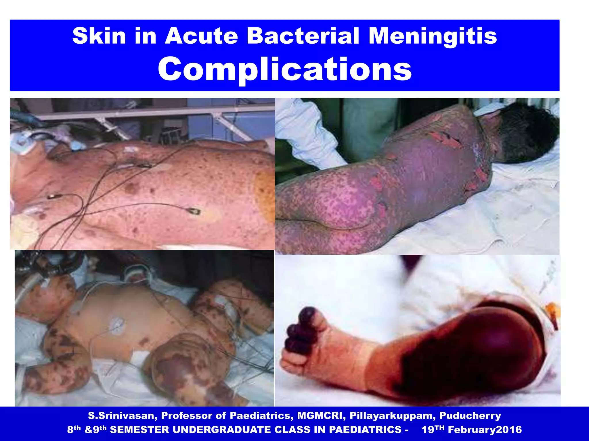 Acute bacterial (Pyogenic) meningitis - Dr. S. Srinivasan, Professor of ...