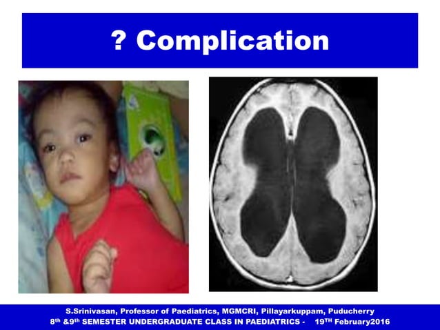 Acute bacterial (Pyogenic) meningitis - Dr. S. Srinivasan, Professor of ...