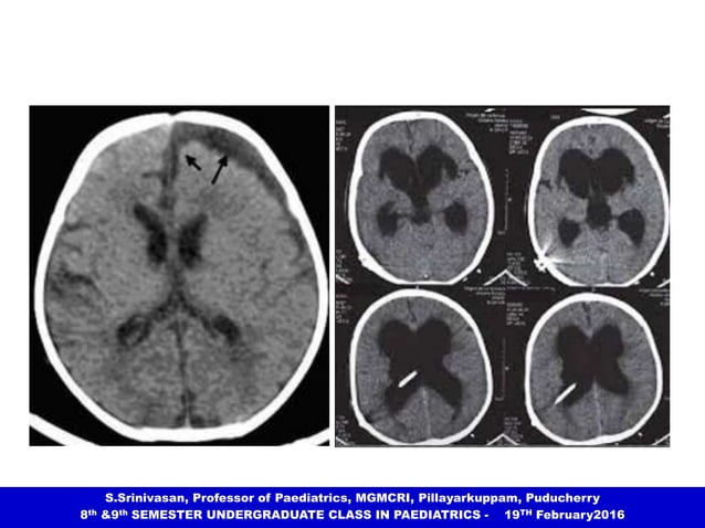 Acute bacterial (Pyogenic) meningitis - Dr. S. Srinivasan, Professor of ...