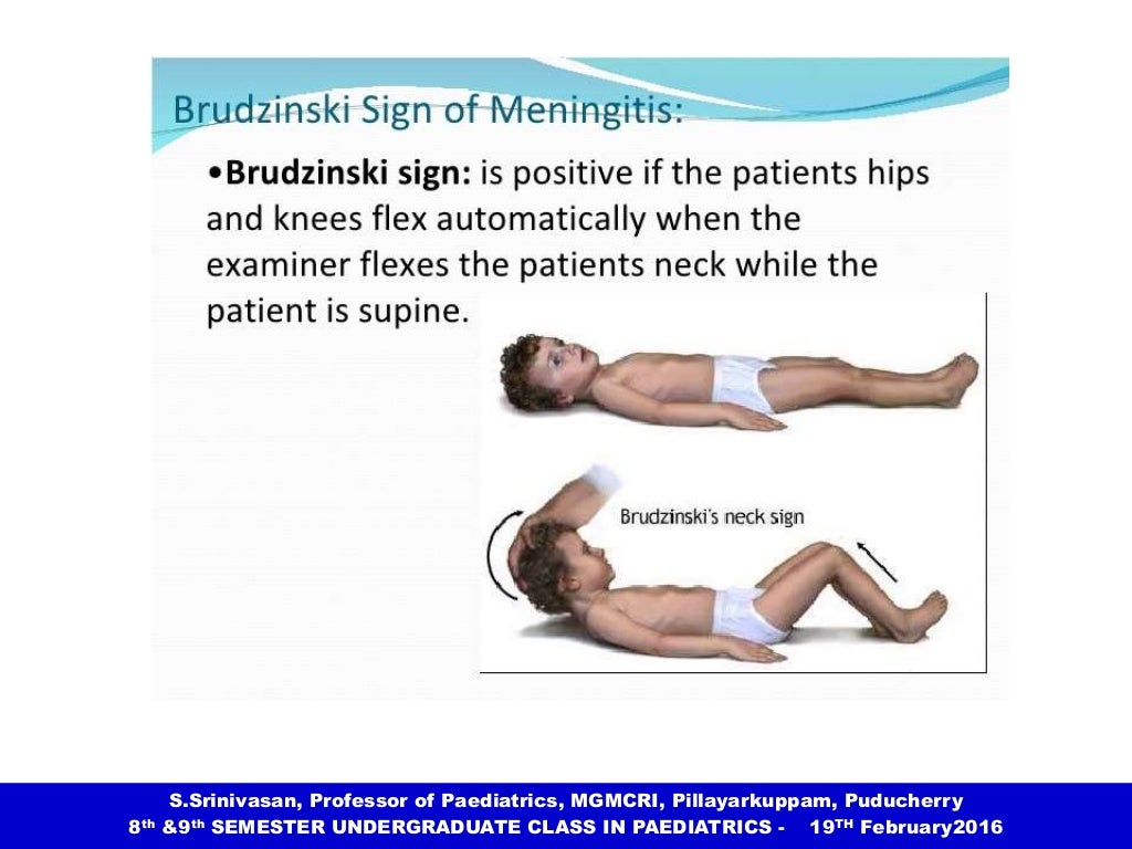 Acute bacterial (Pyogenic) meningitis - Dr. S. Srinivasan, Professor…