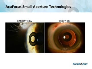 Acufocus | PPT