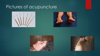 Acupuncture | PPTX