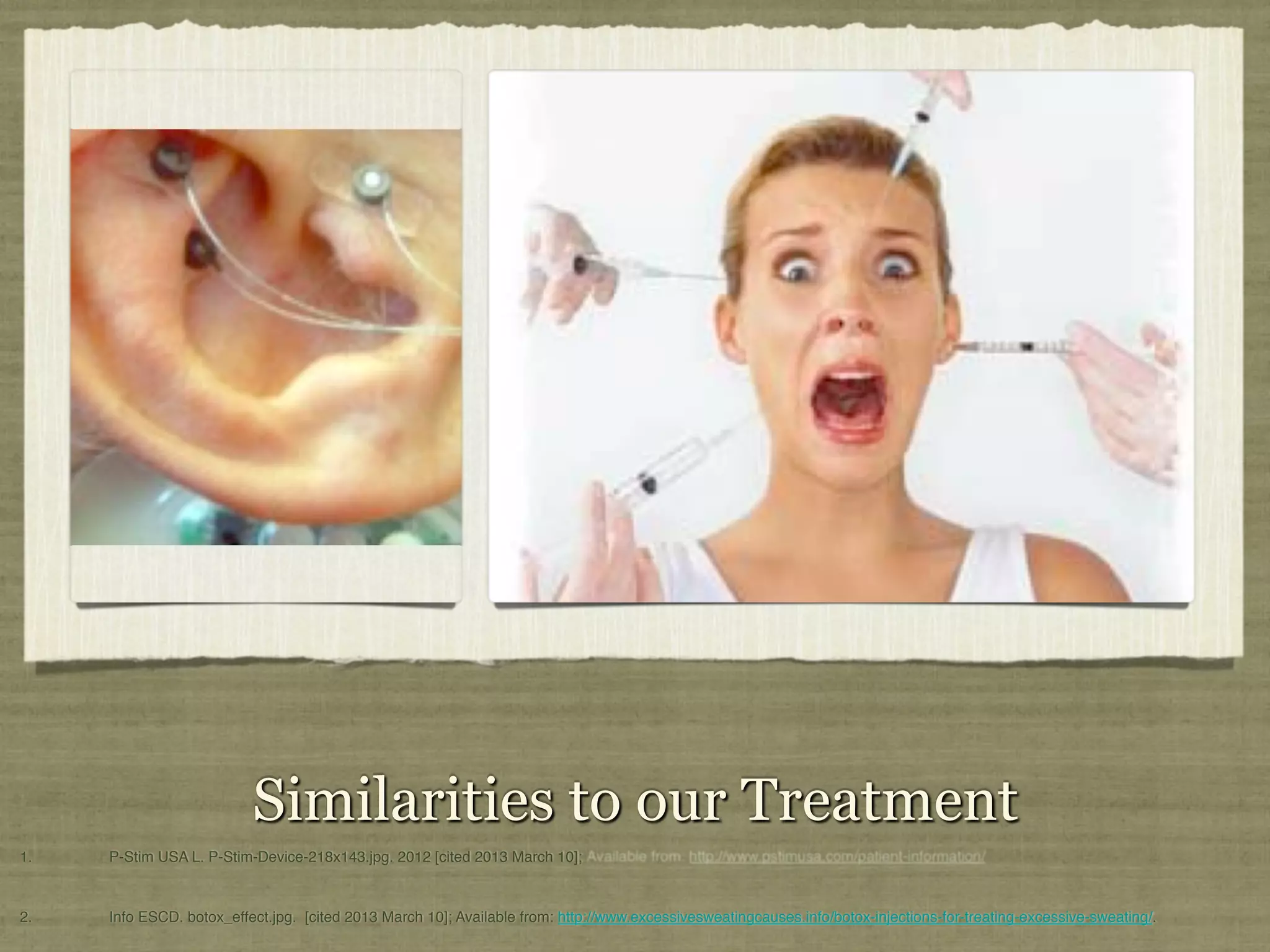 Acupuncture PStim Power Point | PDF
