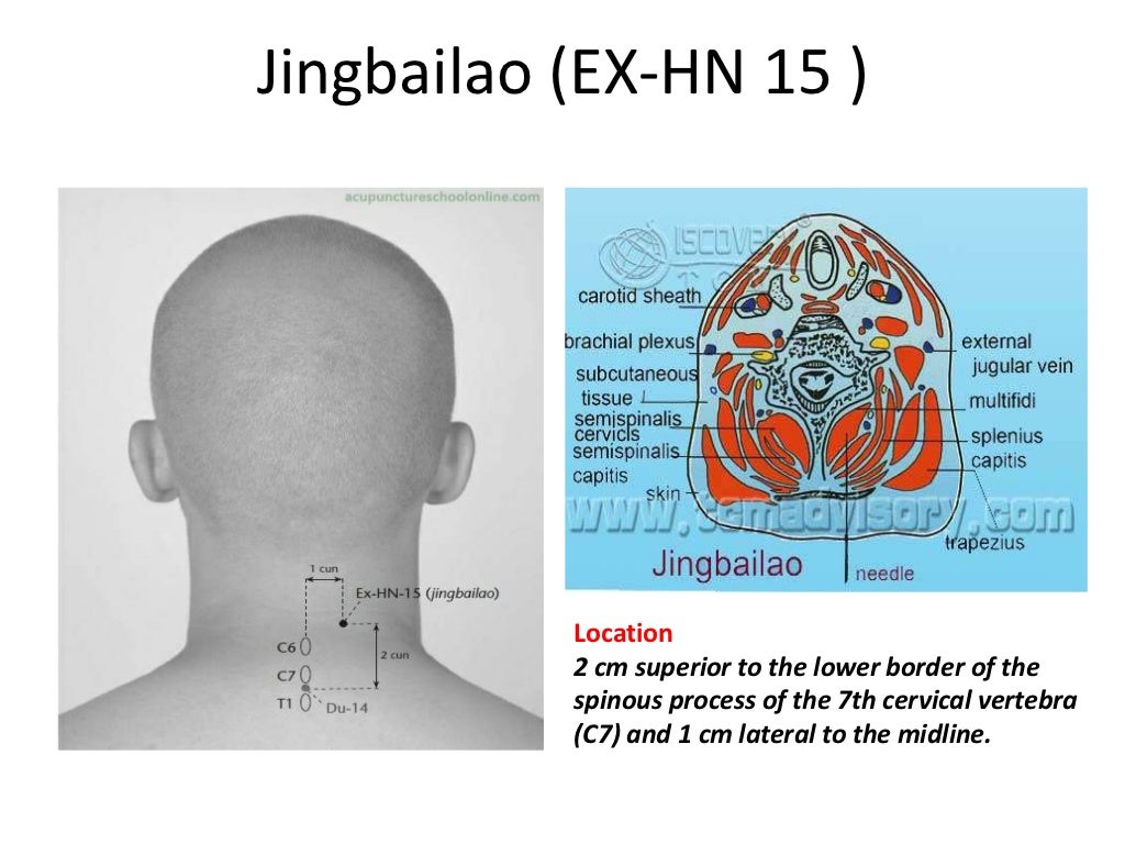 Acupuncture in neck pain