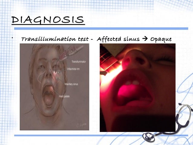 Acute Sinusitis