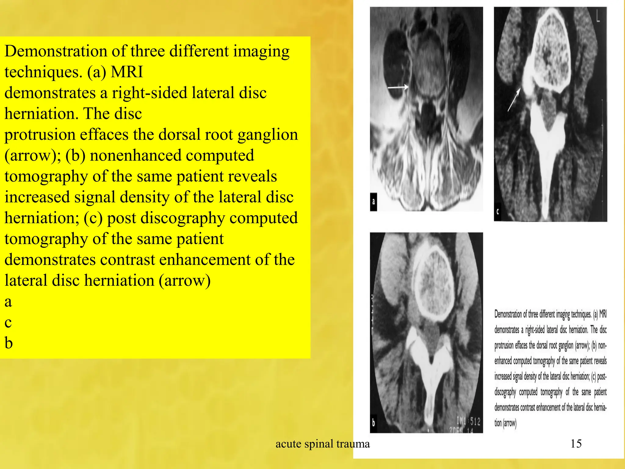 Acute trauma of the spine | PDF | Death, Injury, or Military Conflict ...