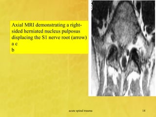 Acute trauma of the spine | PDF | Death, Injury, or Military Conflict ...