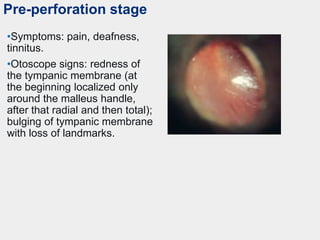 Acute and chronic middle otitis prophylaxis | PPT