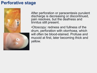 Acute and chronic middle otitis prophylaxis | PPT