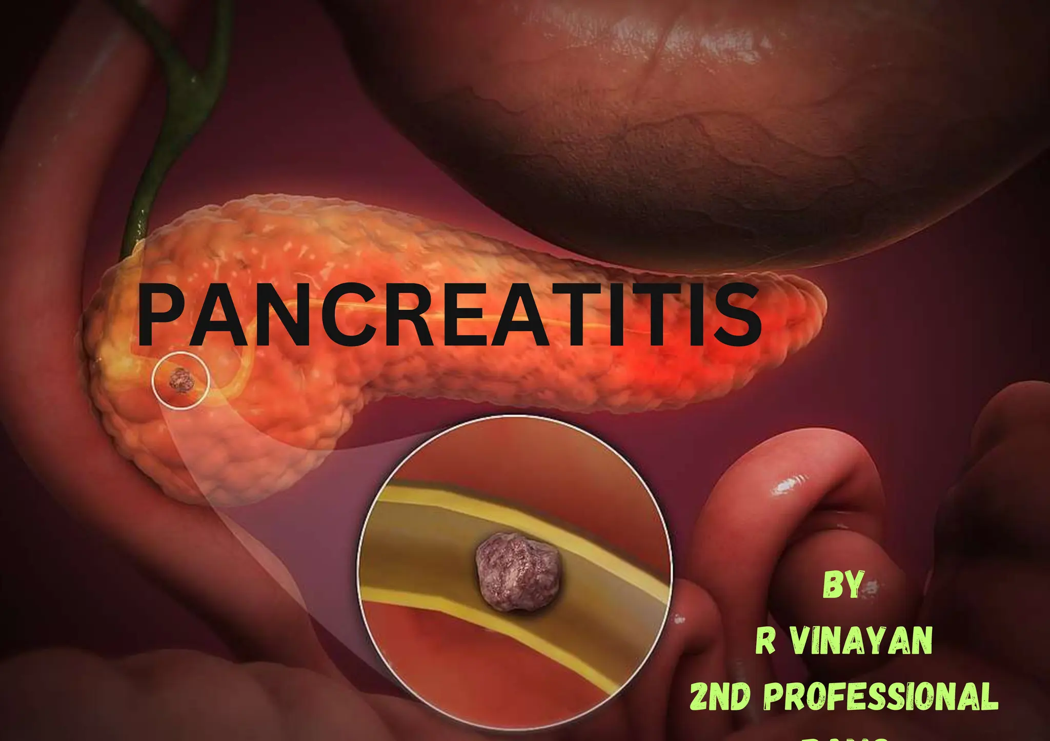 acute-and-chronic-pancreatitis-1-638.pptx_20240310_045509_0000.pptx