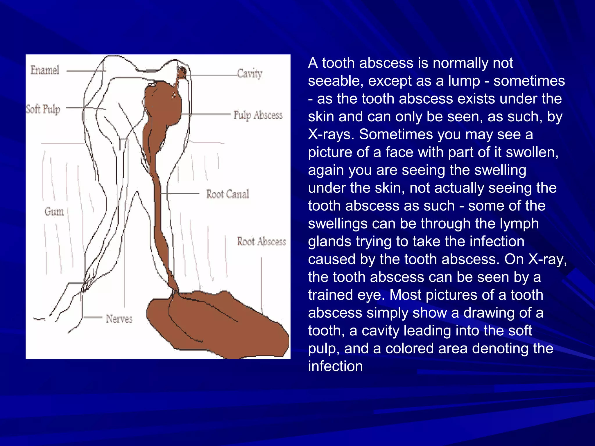 Acute apical-periodontitis.25.mar.2013