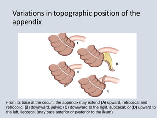 ACUTE APPENDICITIS | PPTX | Digestive Disorders | Diseases and Conditions