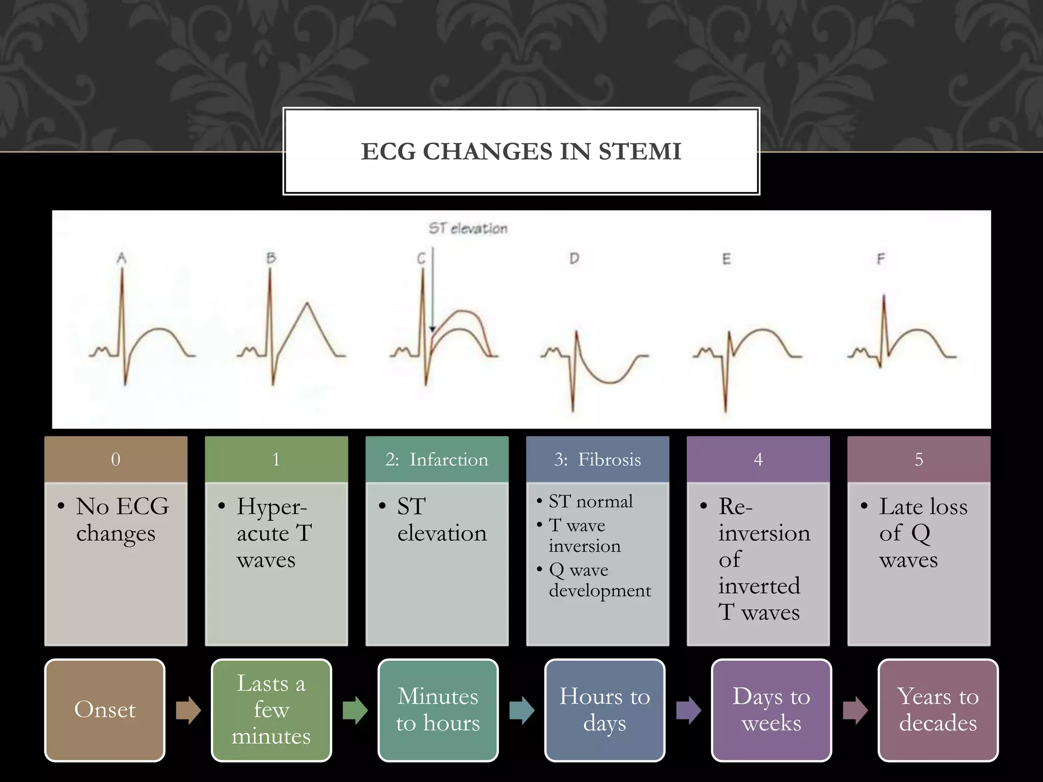 Acute Coronary Syndrome and the ECG | PPTX