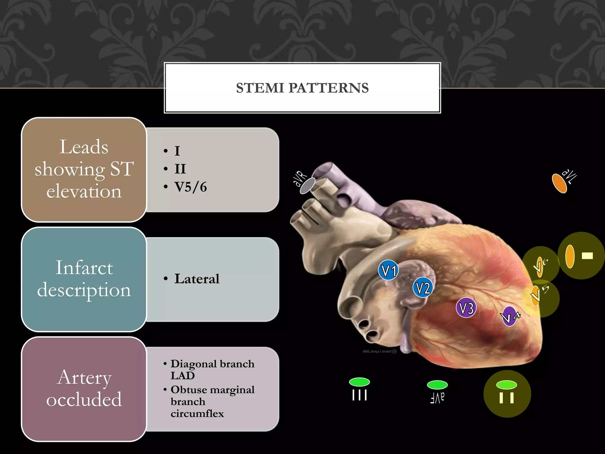 Acute Coronary Syndrome and the ECG | PPTX