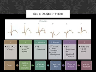 Acute Coronary Syndrome and the ECG | PPTX
