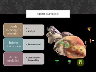 Acute Coronary Syndrome and the ECG | PPTX